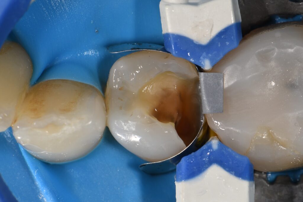 Class II Restorative Solution | Simplishade