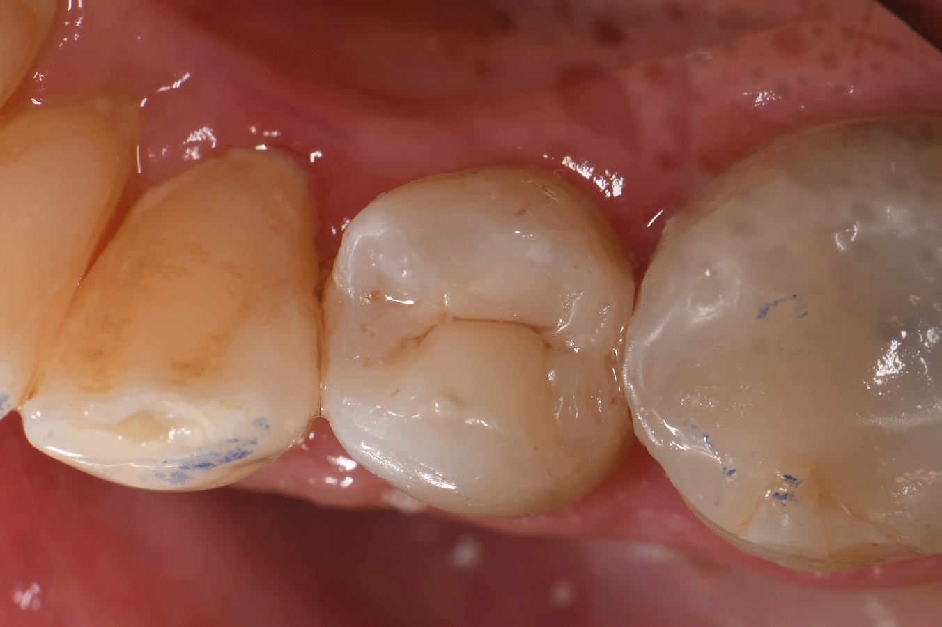 Class II Restorative Solution | Simplishade