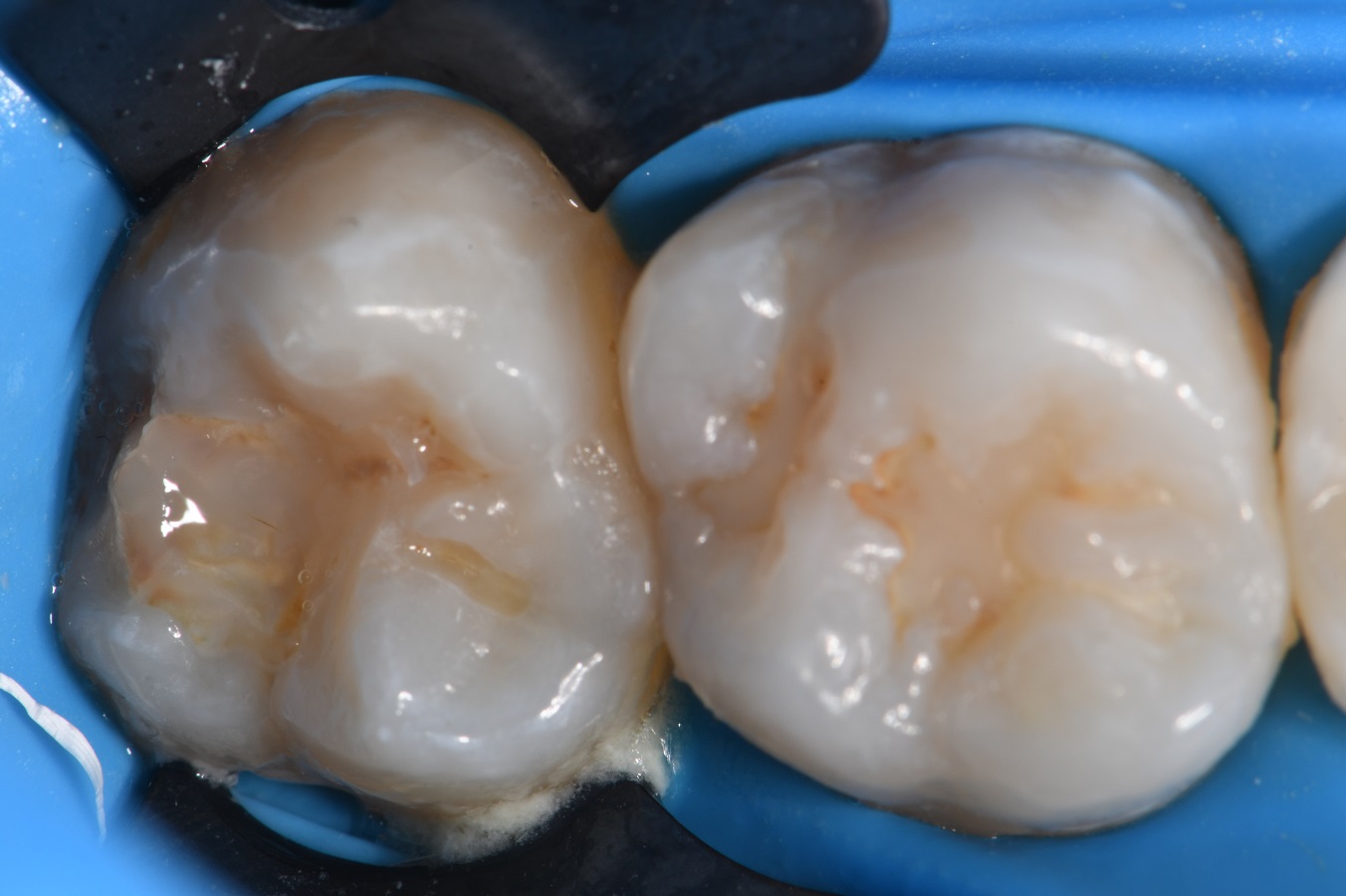 Kerr Simplishade | Class I composite