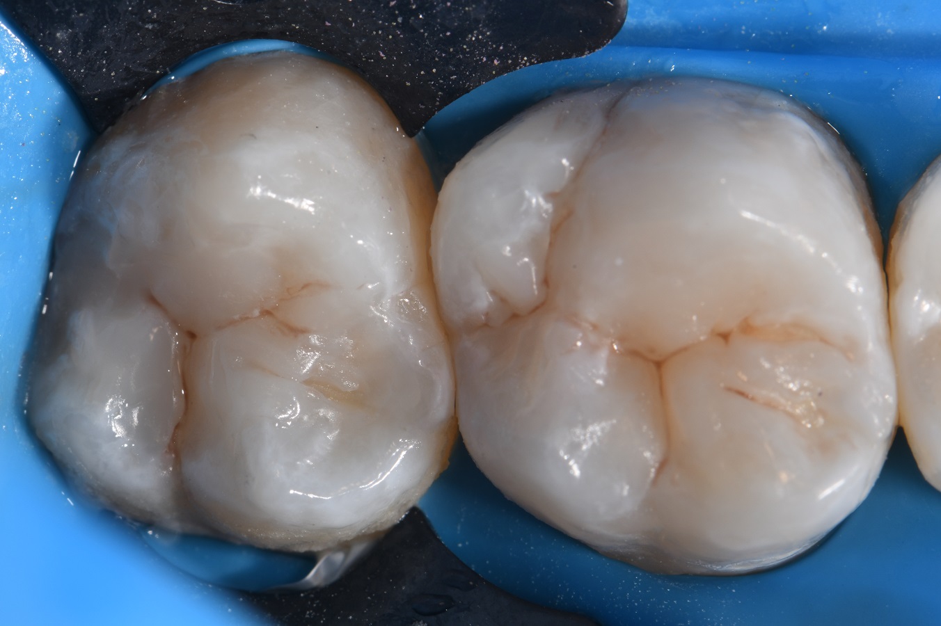 Kerr Simplishade | Class I composite