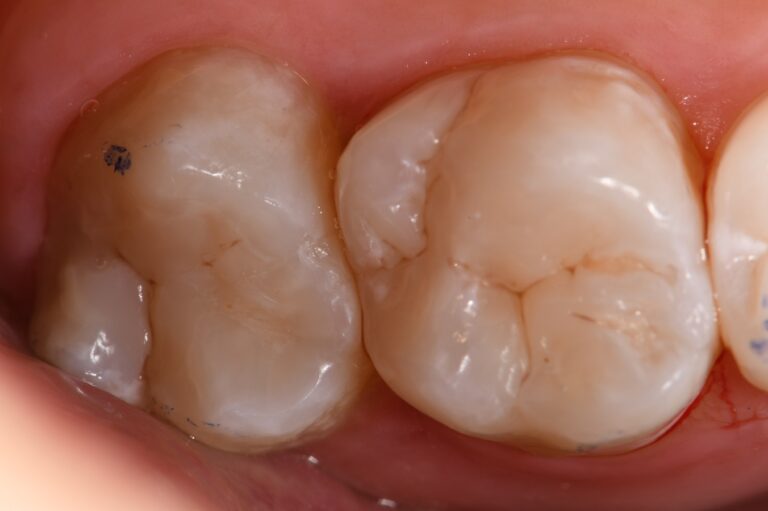 Kerr Simplishade | Class I composite