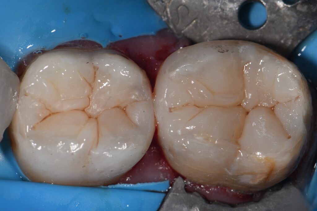 Amalgam Replacement using Complex Composite