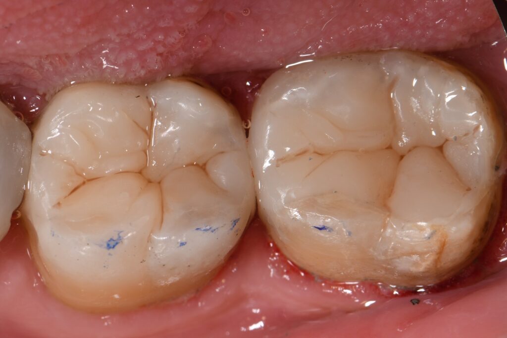 Amalgam Replacement using Complex Composite