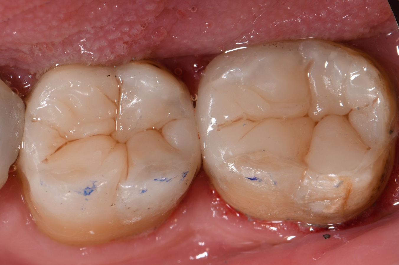 Amalgam Replacement using Complex Composite