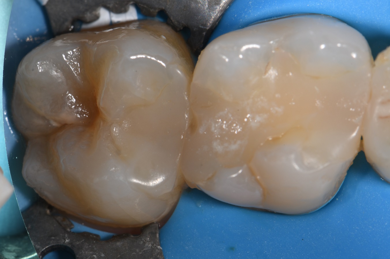 Complex Composite Restoration