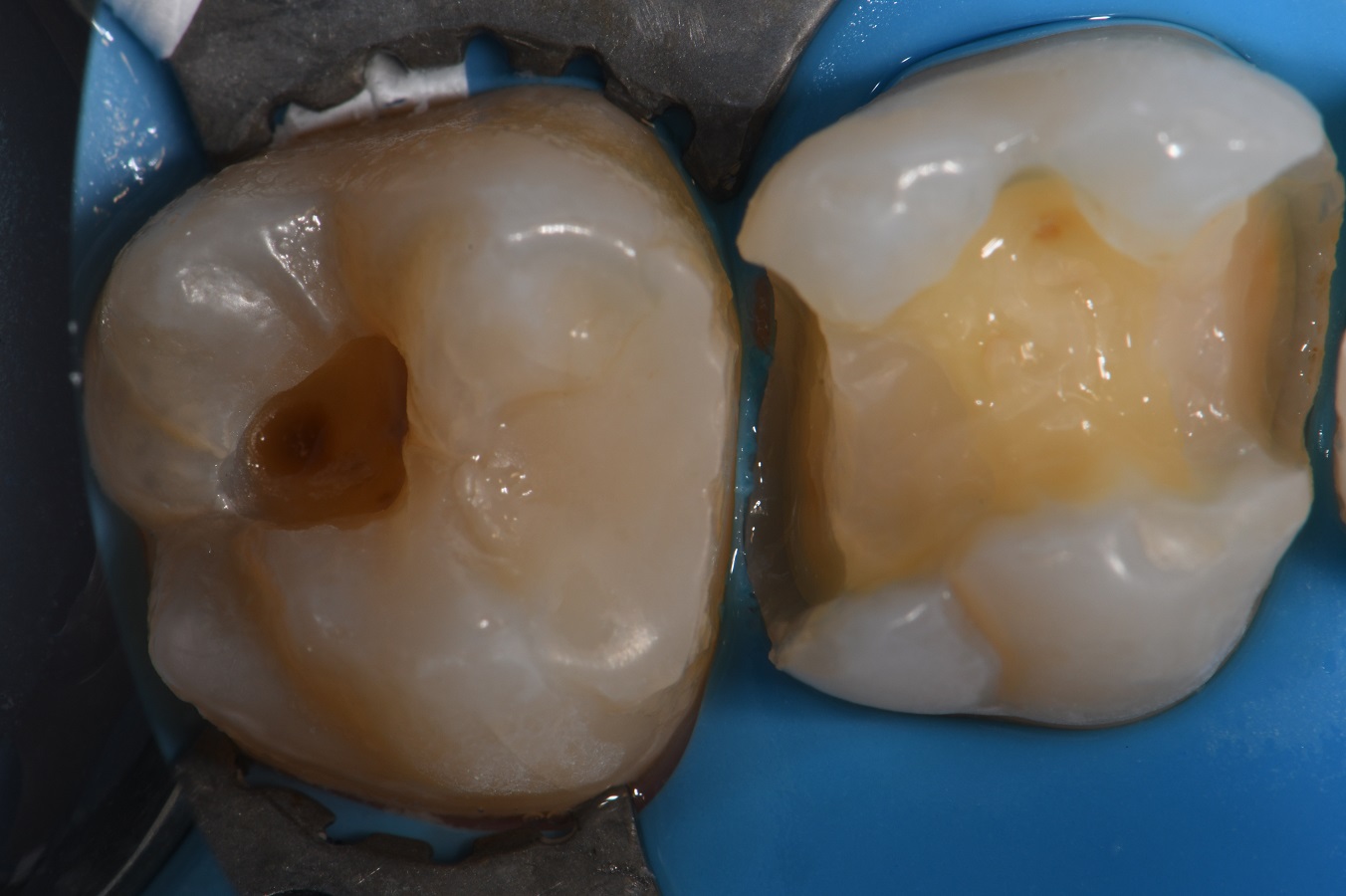 Complex Composite Restoration