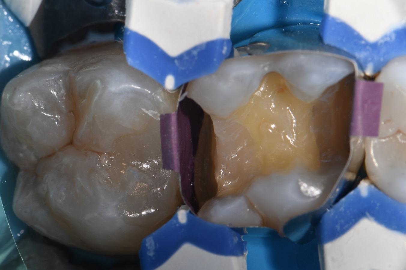 Complex Composite Restoration