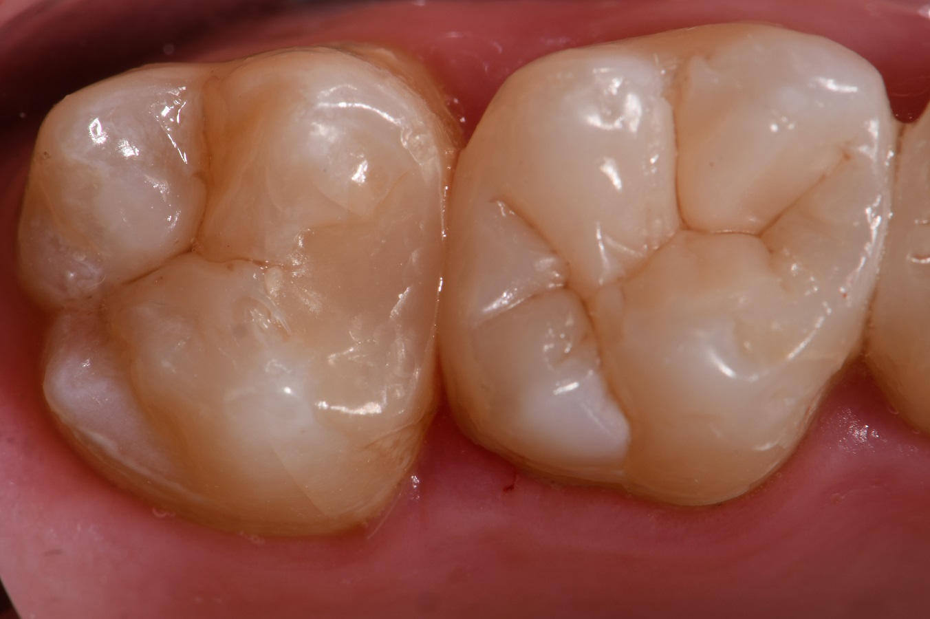 Complex Composite Restoration