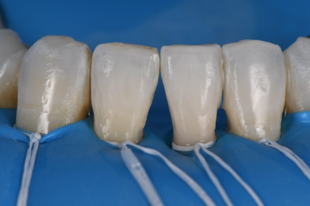 Black Triangle Composite Resin Closure