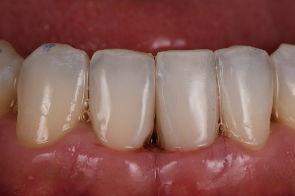 Black Triangle Composite Resin Closure