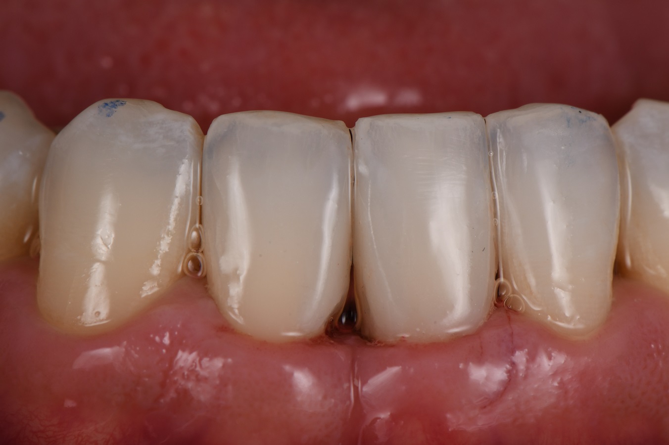 Black Triangle Composite Resin Closure