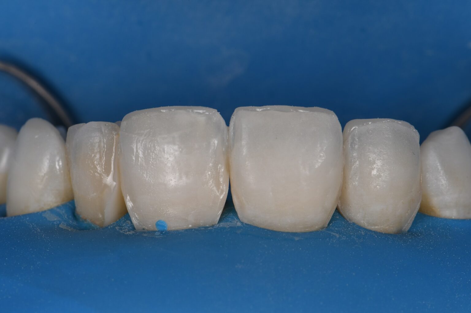 Closing Black Triangles in the Esthetic Zone with Composite
