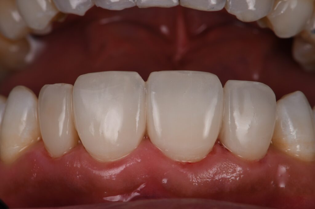 Closing Black Triangles in the Esthetic Zone with Composite