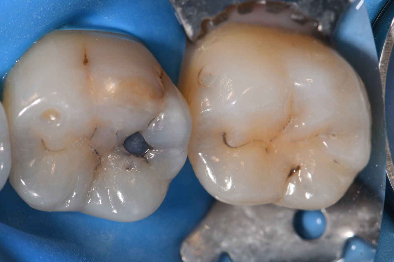 Conservative Composite Restorations Conservative Composite Restorations