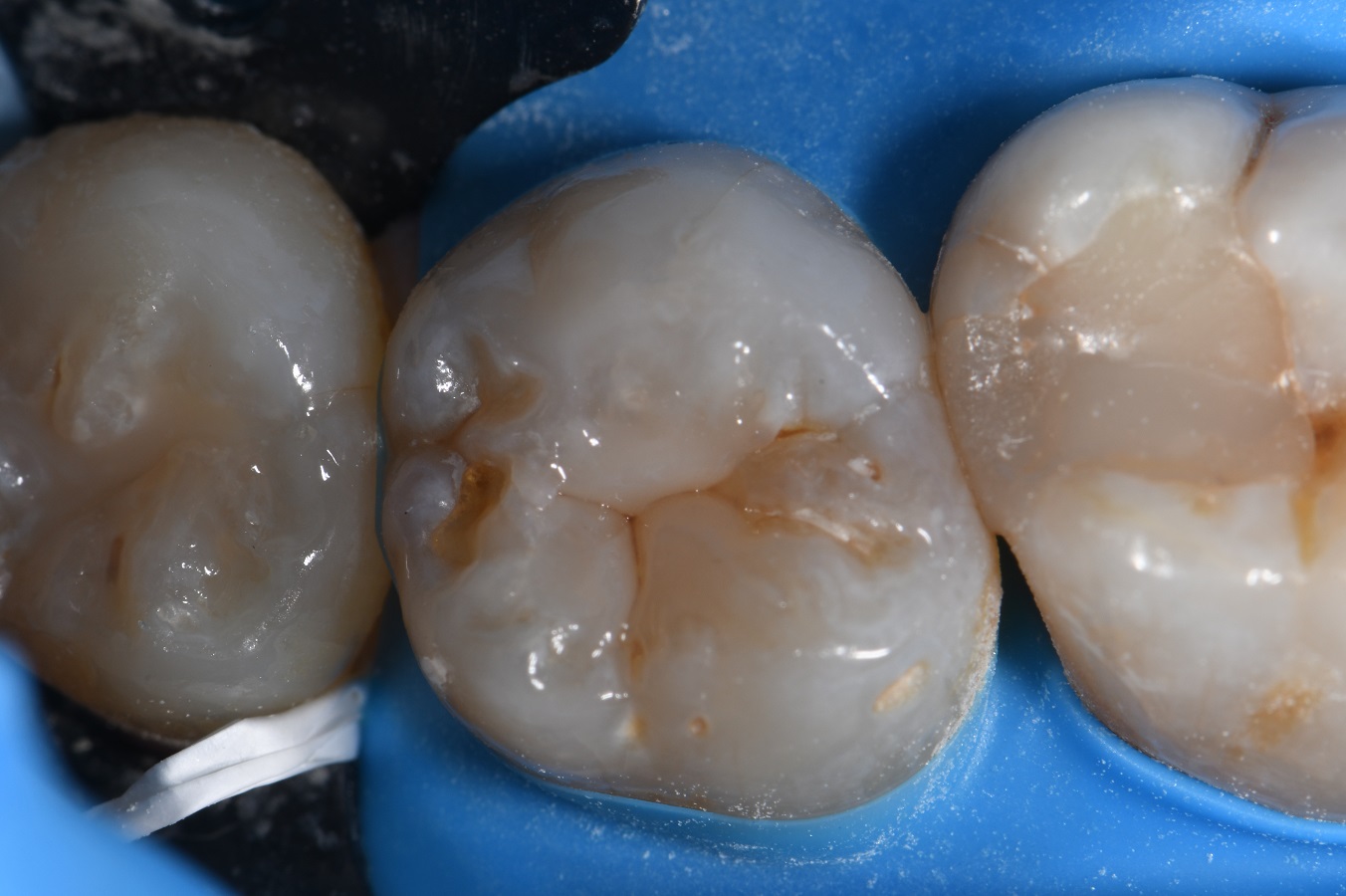 Kerr Simplishade Cavity Restoration