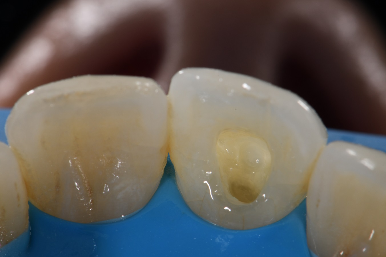 Palatal Root Canal Access Restoration