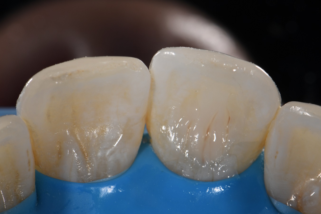 Palatal Root Canal Access Restoration