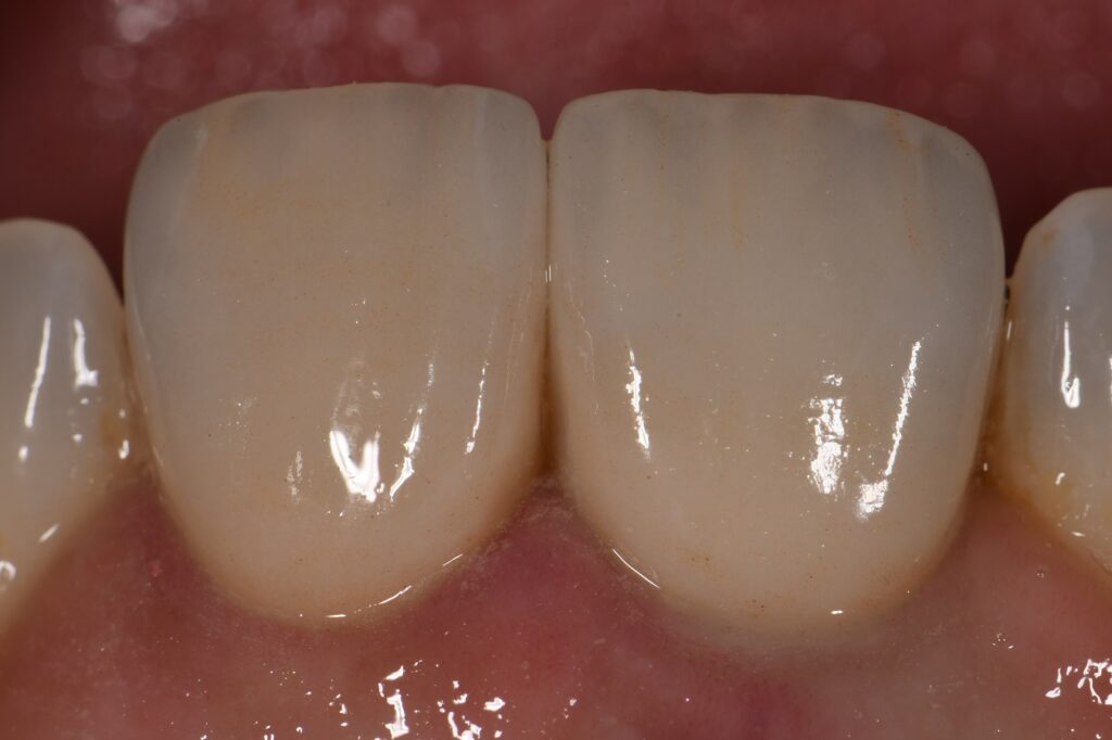 Straumann Angulated Screw Channel
