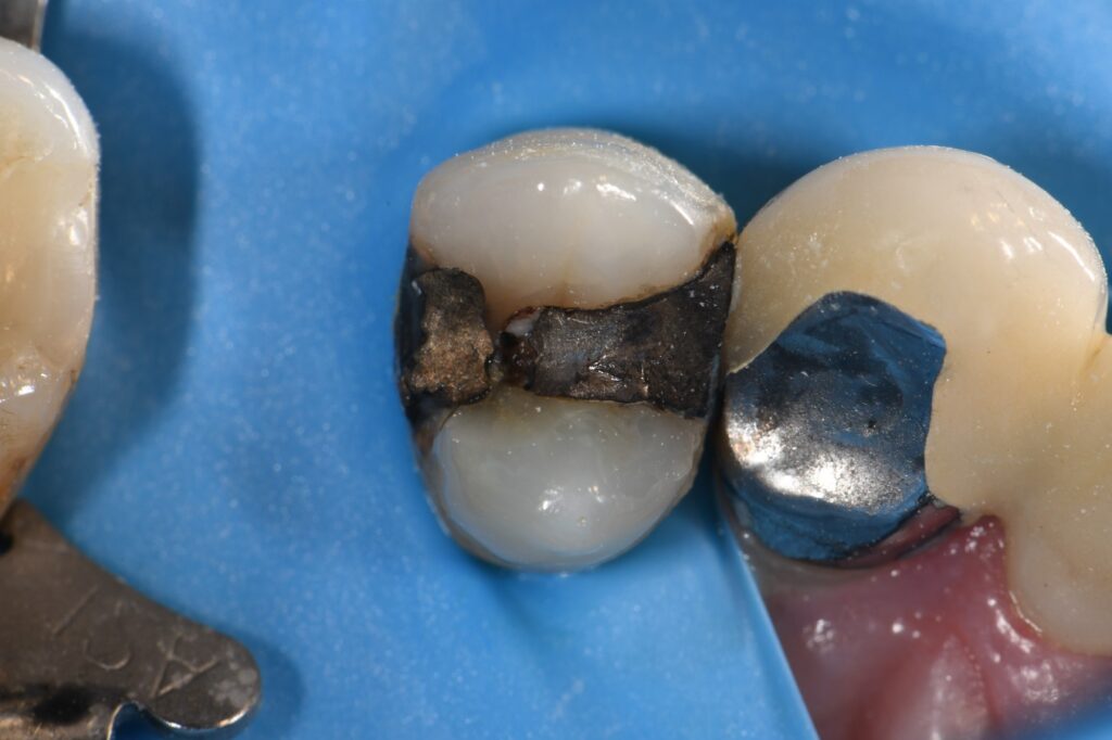 Matrix in Matrix Technique | Class II composite