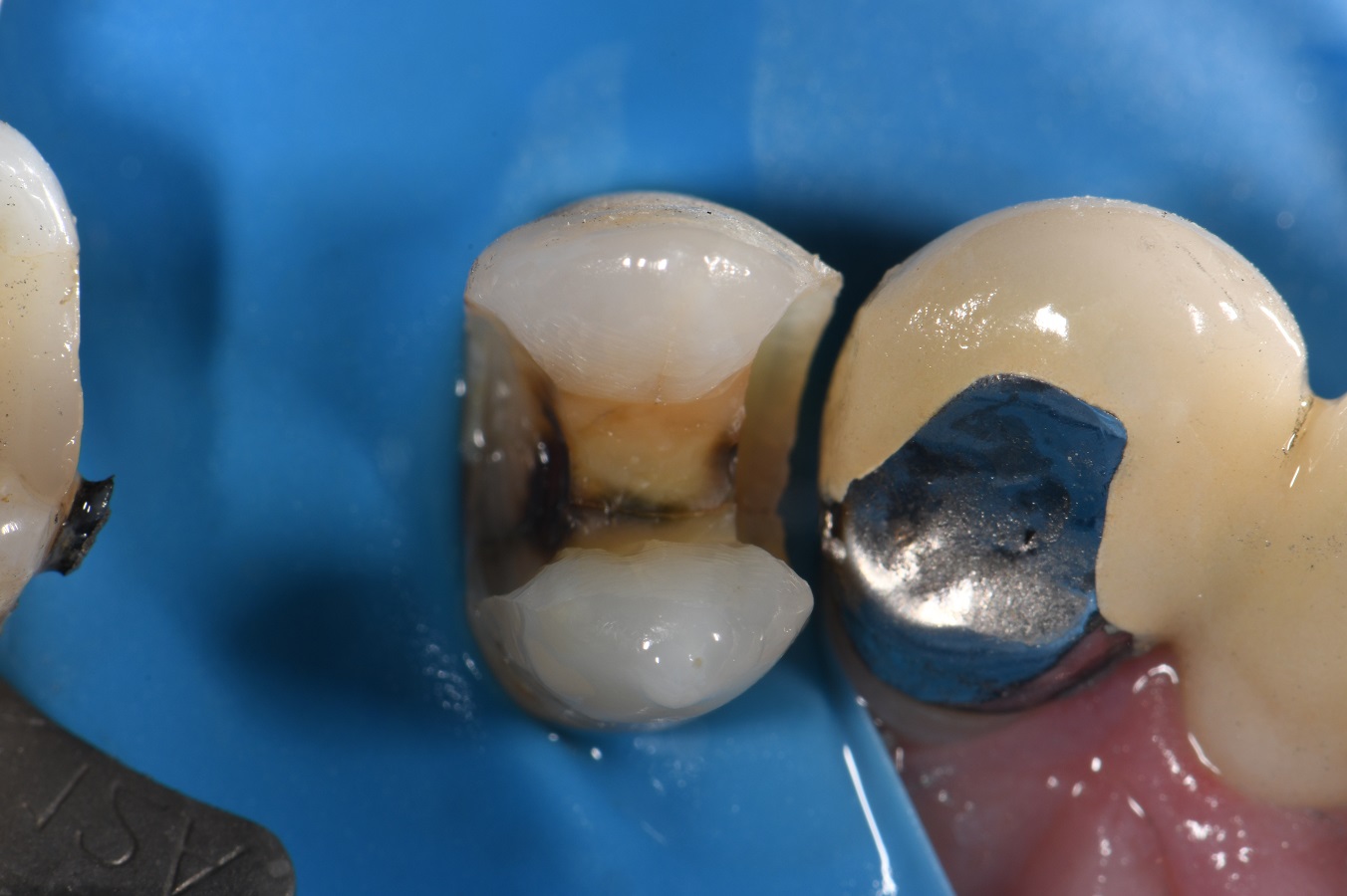 Matrix in Matrix Technique | Class II composite