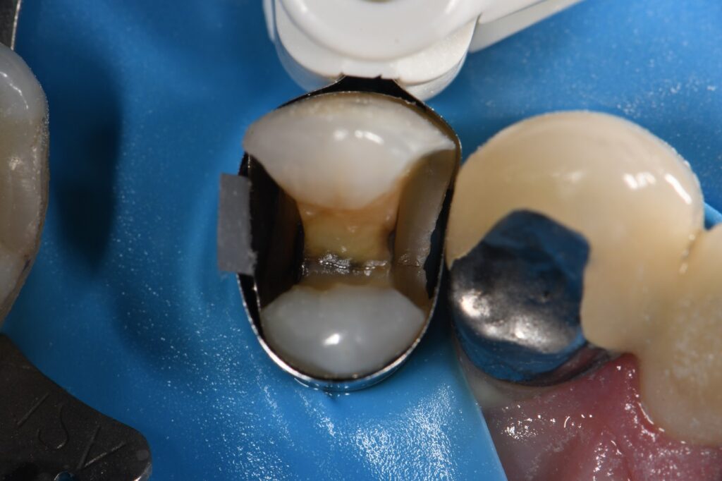 Matrix in Matrix Technique | Class II composite