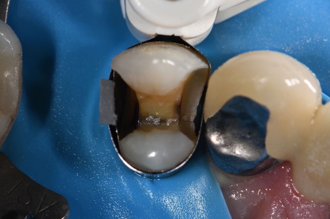 Matrix in Matrix Technique | Class II composite