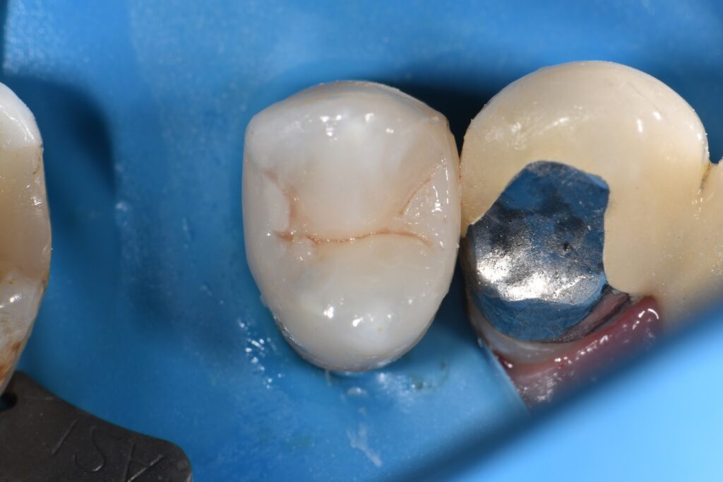 Matrix in Matrix Technique | Class II composite