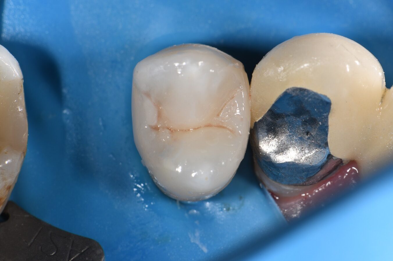 Matrix in Matrix Technique | Class II composite