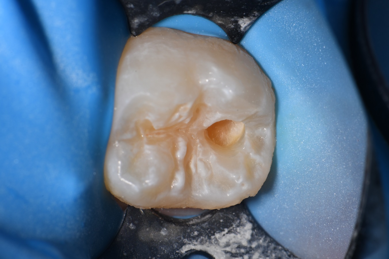 Exploratory fissurotomy | Kerr Simplishade