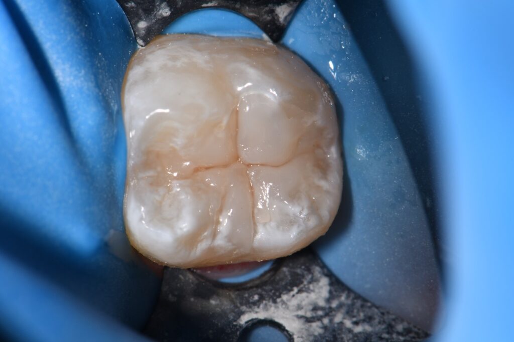 Exploratory fissurotomy | Kerr Simplishade