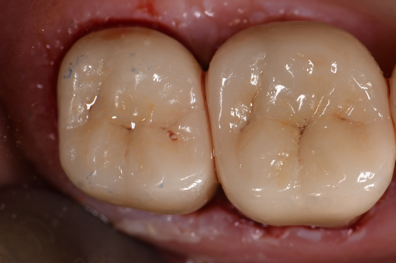 Saving Near Hopeless Teeth Saving Near Hopeless Teeth