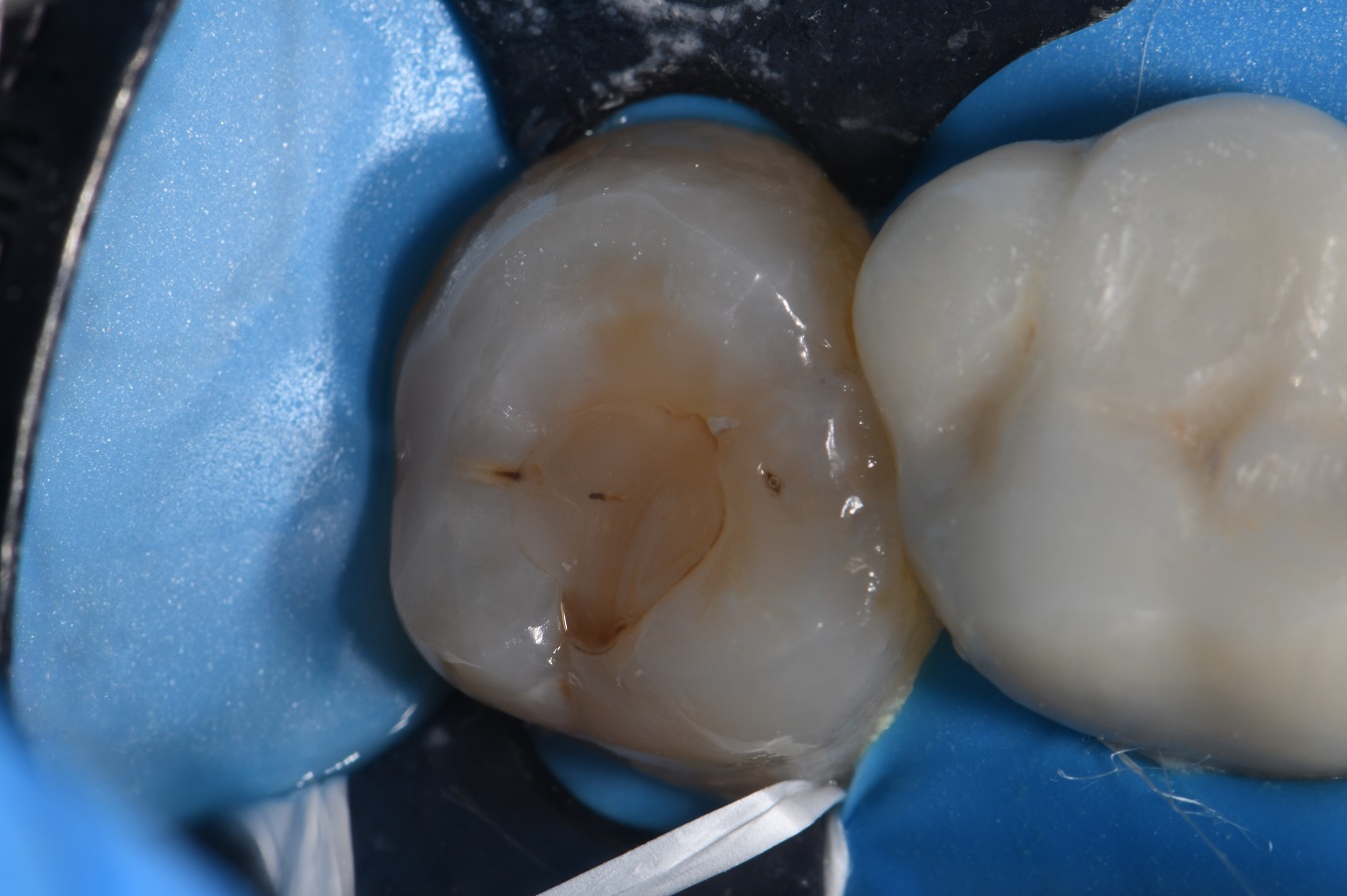 Restoring Marginal Leakage in Composite Fillings