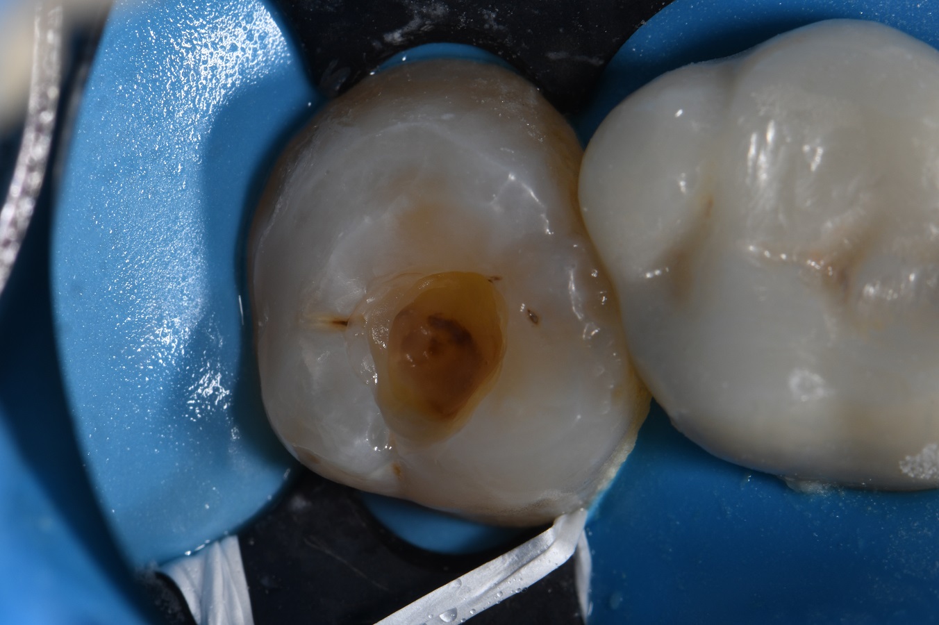 Restoring Marginal Leakage in Composite Fillings