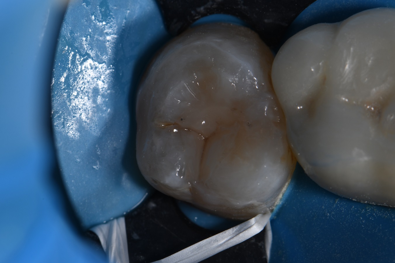 Restoring Marginal Leakage in Composite Fillings