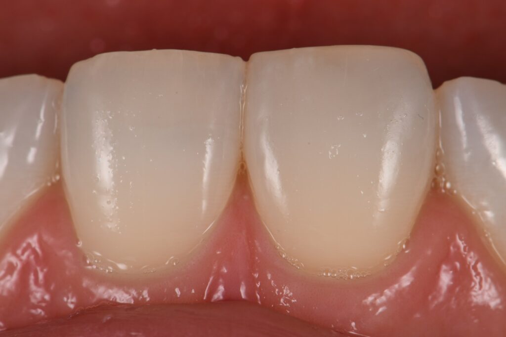 Invisible Composite Layering Invisible Composite Layering