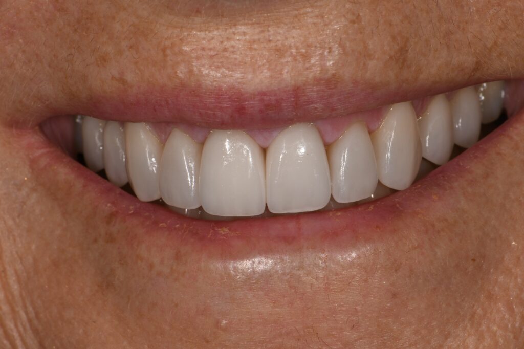 Extreme Dental | Smile Makeover Extreme Dental | Smile Makeover
