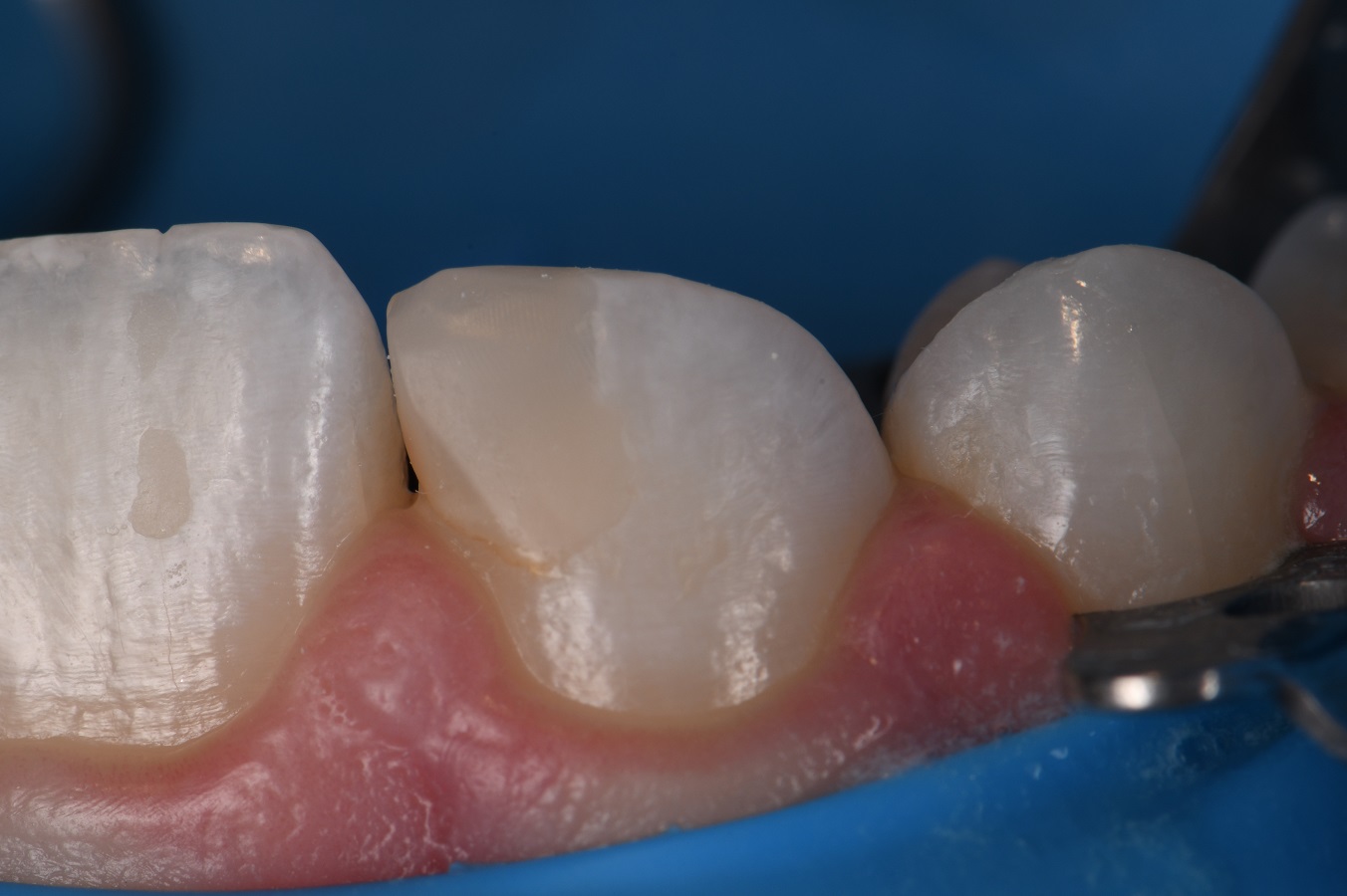 Composite Canine Substitution Layering