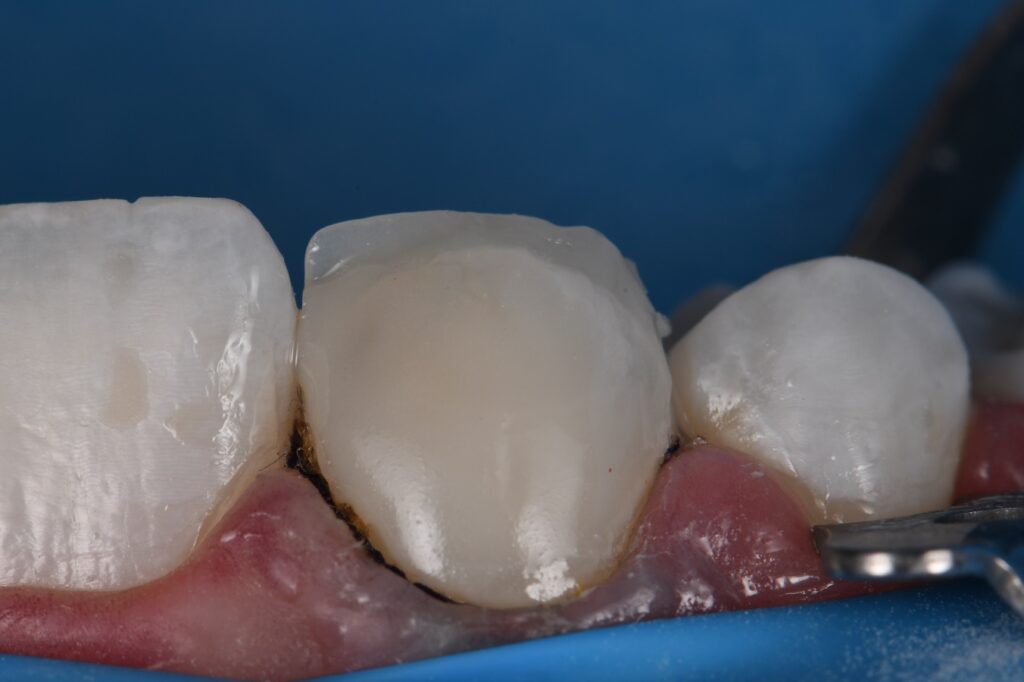 Composite Canine Substitution Layering