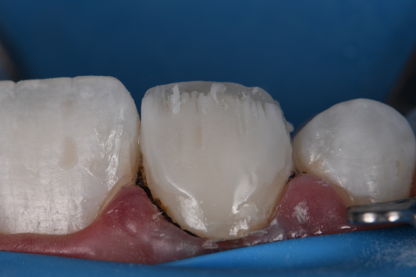 Composite Canine Substitution Layering