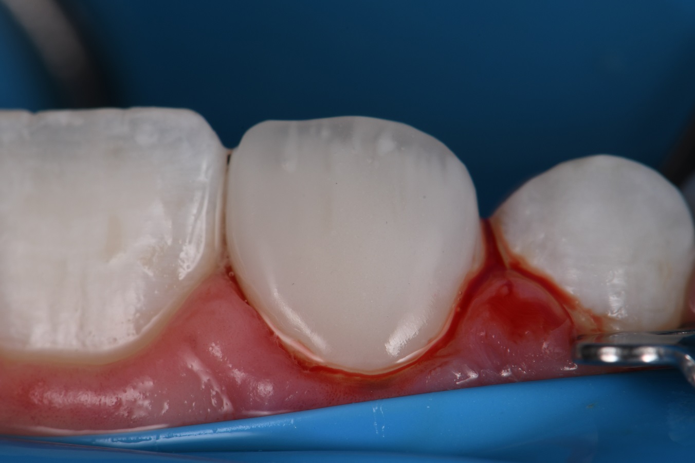 Composite Canine Substitution Layering