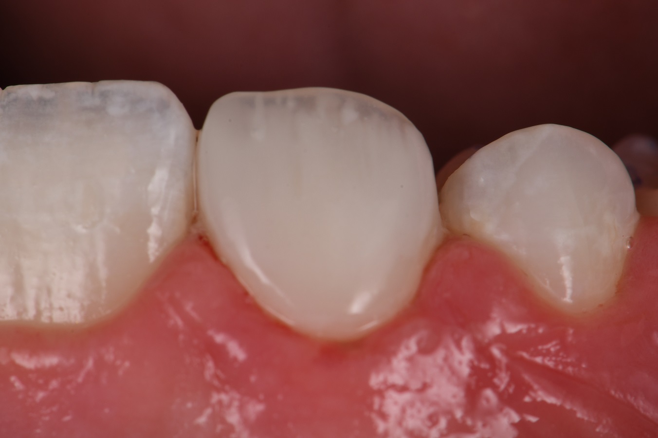 Composite Canine Substitution Layering