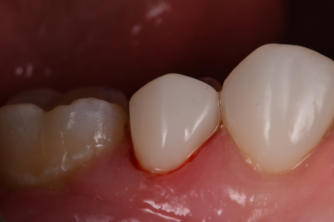 Composite Veneers to Reduce Buccal Corridor