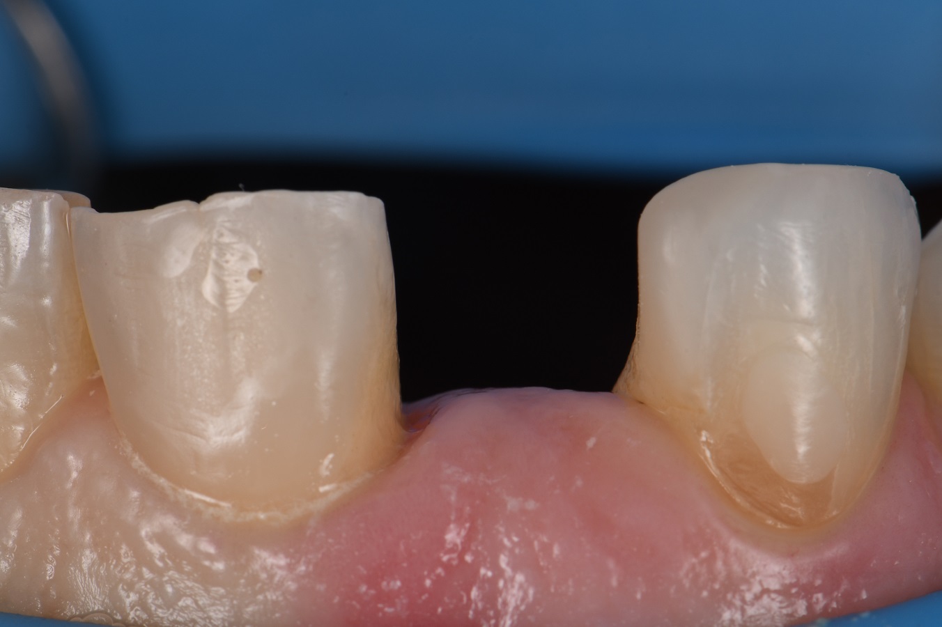 Freehand Resin Bonded Composite Bridge | Voco GrandTEC