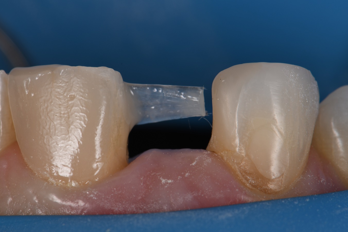 Freehand Resin Bonded Composite Bridge | Voco GrandTEC