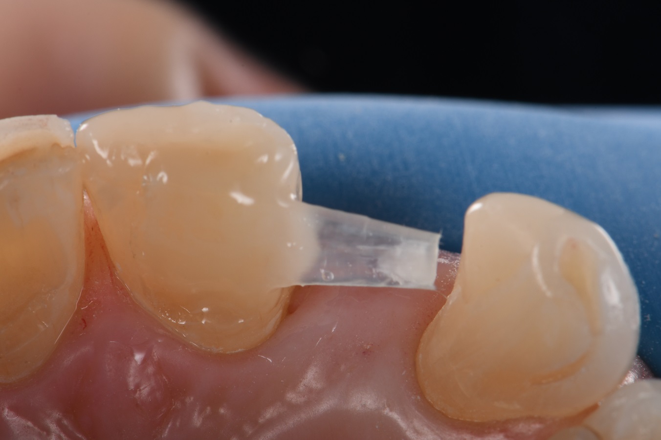 Freehand Resin Bonded Composite Bridge | Voco GrandTEC