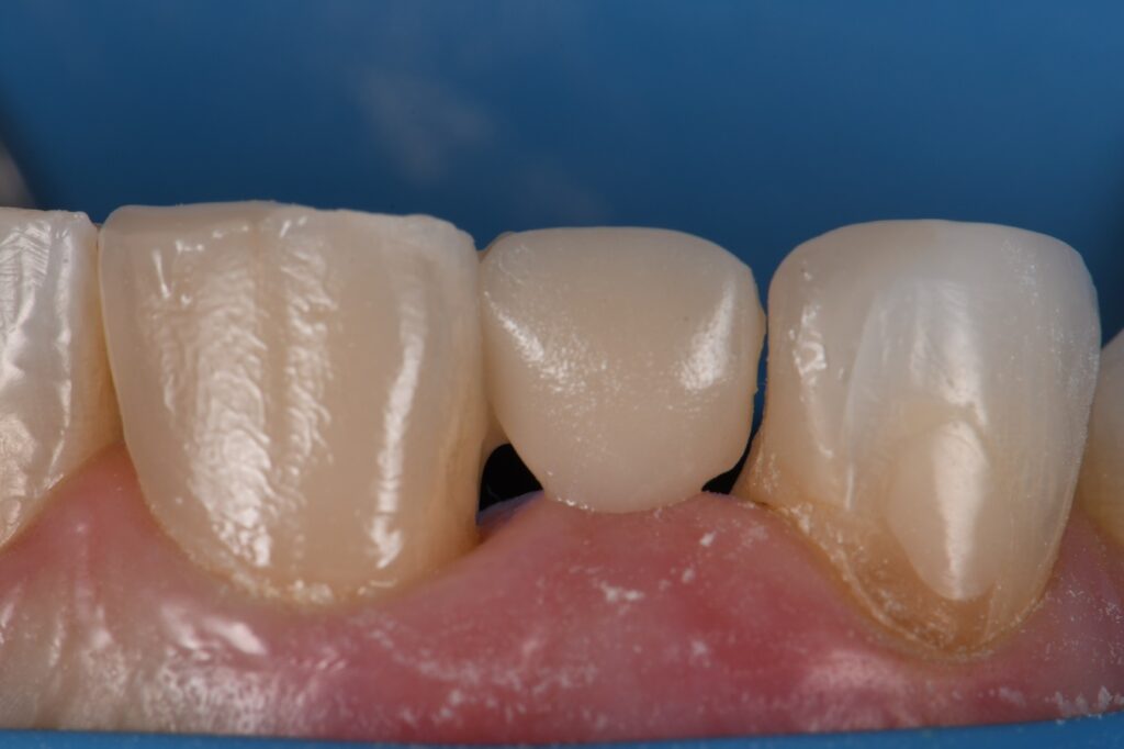 Freehand Resin Bonded Composite Bridge | Voco GrandTEC