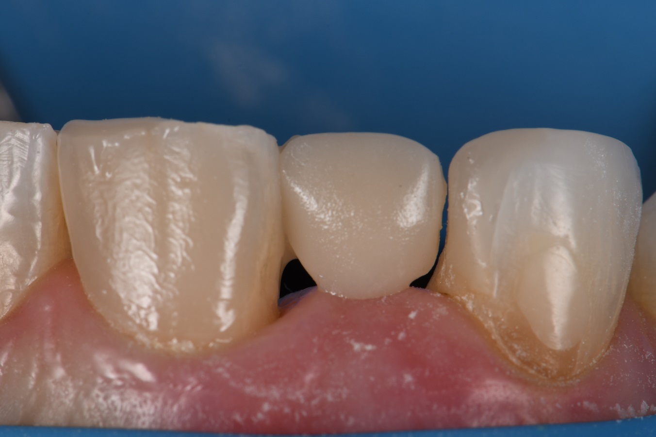 Freehand Resin Bonded Composite Bridge | Voco GrandTEC