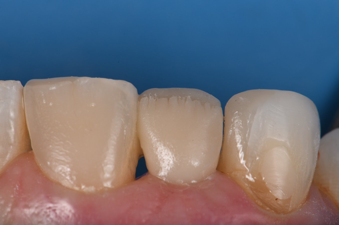 Freehand Resin Bonded Composite Bridge | Voco GrandTEC