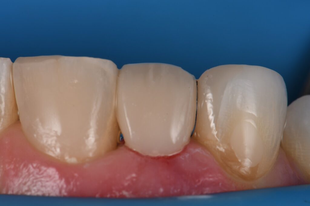 Freehand Resin Bonded Composite Bridge | Voco GrandTEC