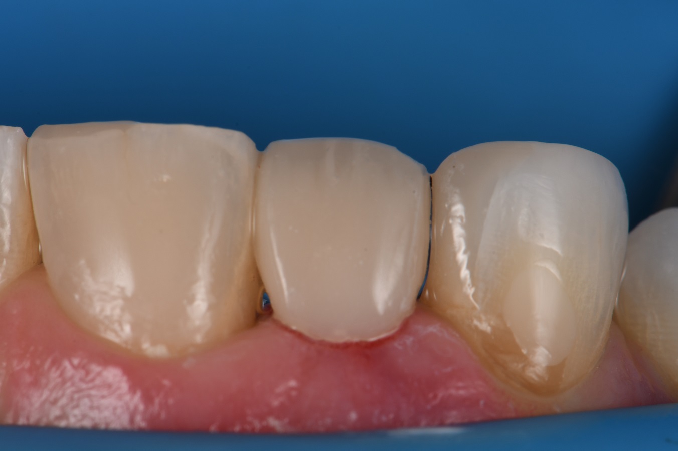 Freehand Resin Bonded Composite Bridge | Voco GrandTEC